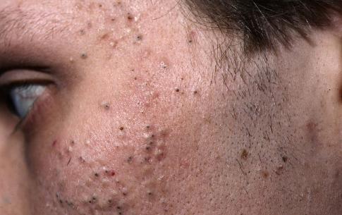 Hudorme. Årsag og behandling | iSUNDHED.dk