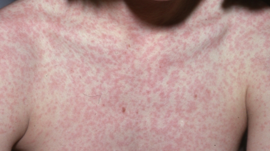 Ringorm (tinea corporis) diagnose og behandling | iSUNDHED.dk